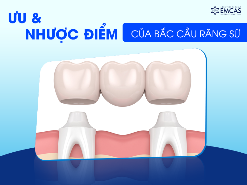 Bắc Cầu Răng Sứ - Giải Pháp Phục Hình Răng Mất Hiệu Quả